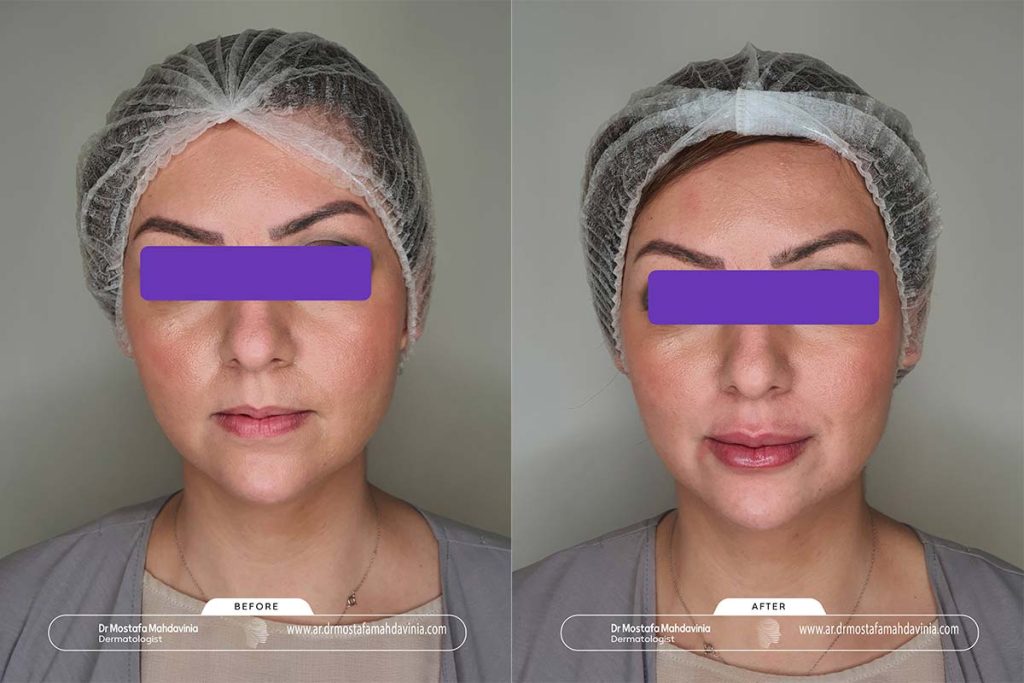 Gel injections - Dr. Mostafa Mahdavi