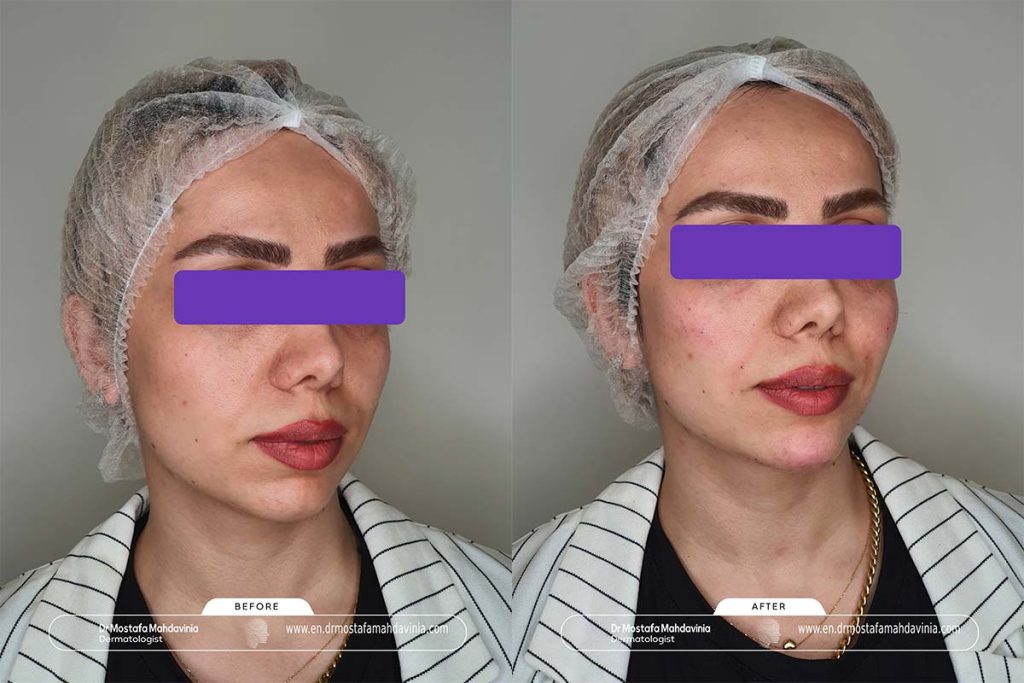 Gel injections - Dr. Mostafa Mahdavi